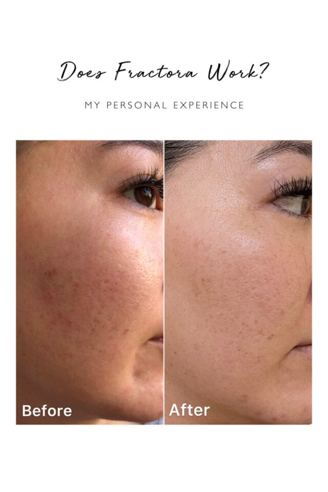 Fractora Treatment: Before/After Pics & My HONEST Experience