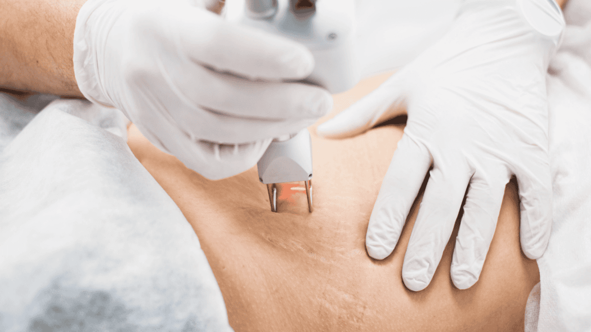 13 Proven Ways to Fade Pesky Stretch Marks